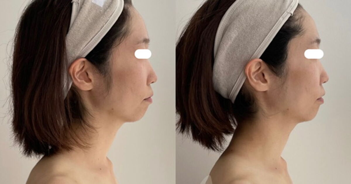 【PARAFUSE.脳洗浄】Before→After | 神戸で培ったエステに関する専門知識をわかりやすく発信します